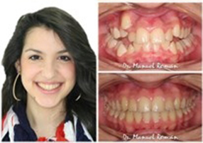 Biprotrusión dental. Fotos antes y después con ortodoncia invisible