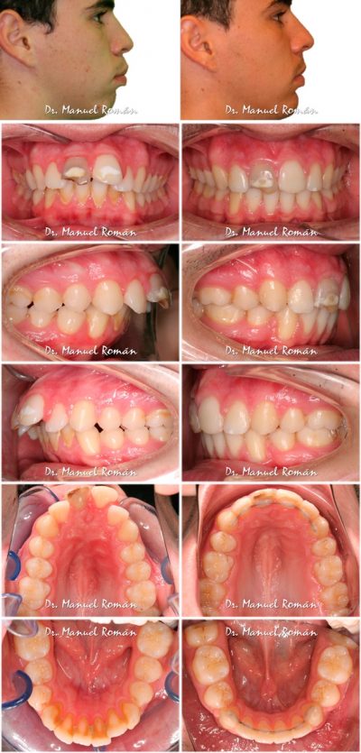 Biprotrusión dental. Fotos antes y después con ortodoncia invisible