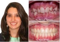 Clase II con Twin-Block | Invisible Invisalign - Dr. Manuel Roman