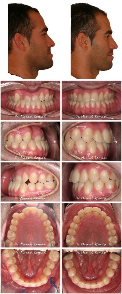 Clase III esquelética. Fotos antes y después ortodoncia invisible