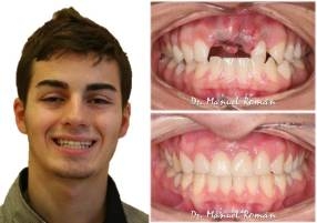 Biprotrusión dental. Fotos antes y después con ortodoncia invisible