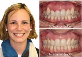 Biprotrusión dental. Fotos antes y después con ortodoncia invisible