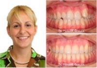 Biprotrusión dental. Fotos antes y después con ortodoncia invisible