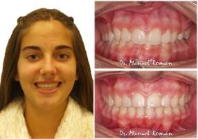 Biprotrusión dental. Fotos antes y después con ortodoncia invisible