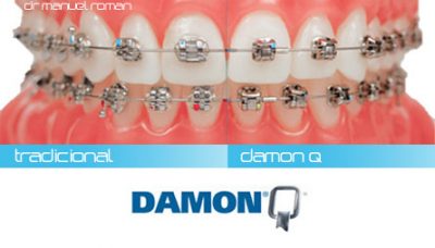 Damon Q | Invisible Invisalign - Dr. Manuel Roman