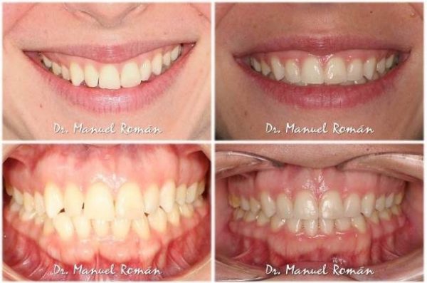 Linea media dental | Invisible Invisalign - Dr. Manuel Roman