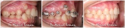 Ortodoncia Rapida Brackets | Invisible Invisalign - Dr. Manuel Roman